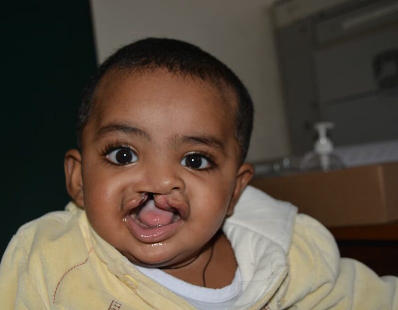 What is Cleft? - Transforming Cleft