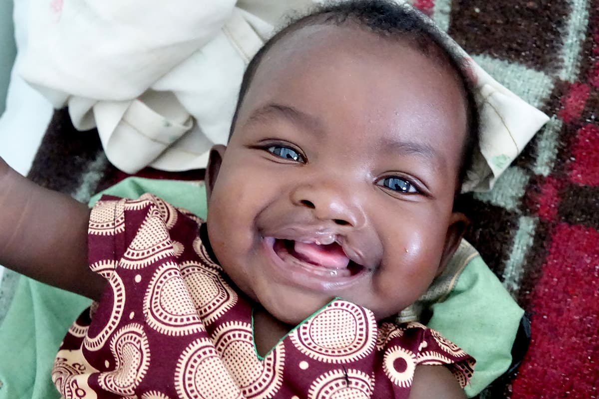 Esther & Her Family Access Comprehensive Cleft Care in Uganda ...