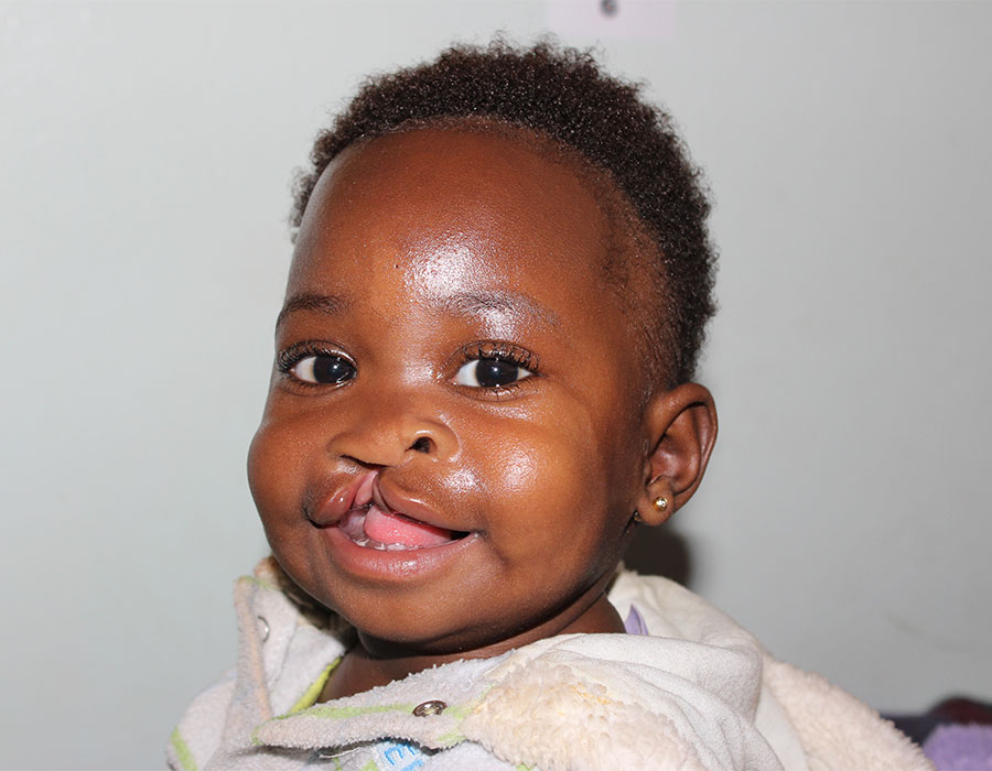Uganda: Meet Prossy - Transforming Cleft